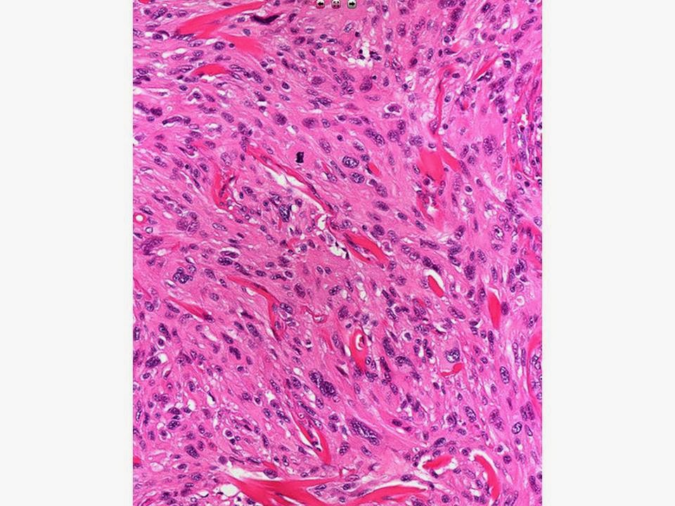 Dermpath Made Simple - Neoplastic: Atypical Fibroxanthoma