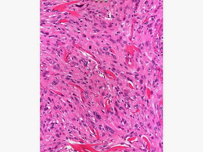 Dermpath Made Simple - Neoplastic: Atypical Fibroxanthoma