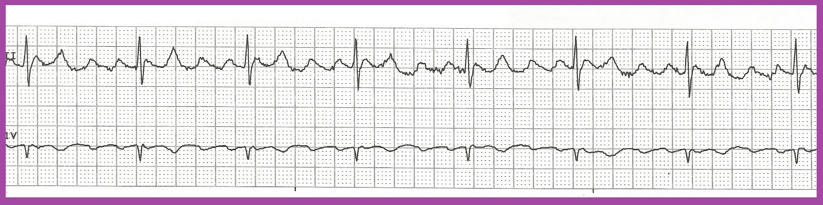 Practice EKG Rhythm Strips 192