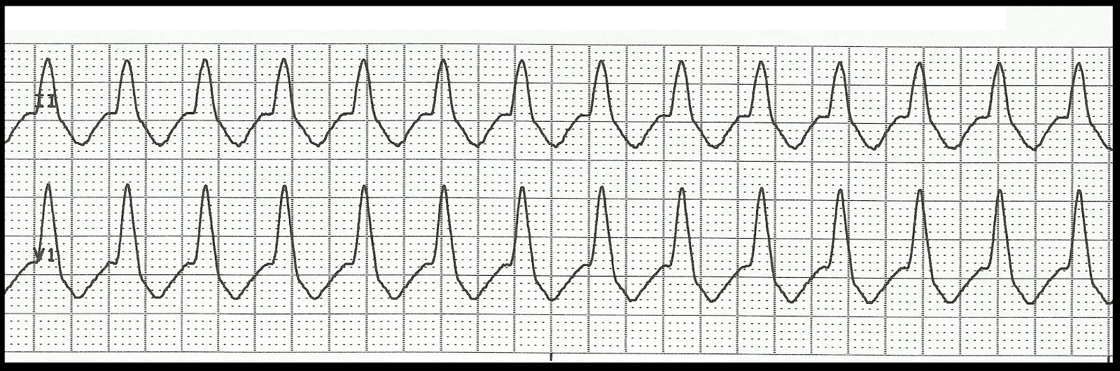Monomorphic Ventricular Tachycardia