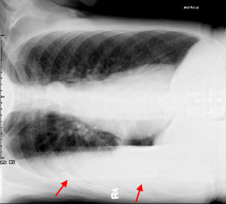 Chest Section: -Lateral decubitus film