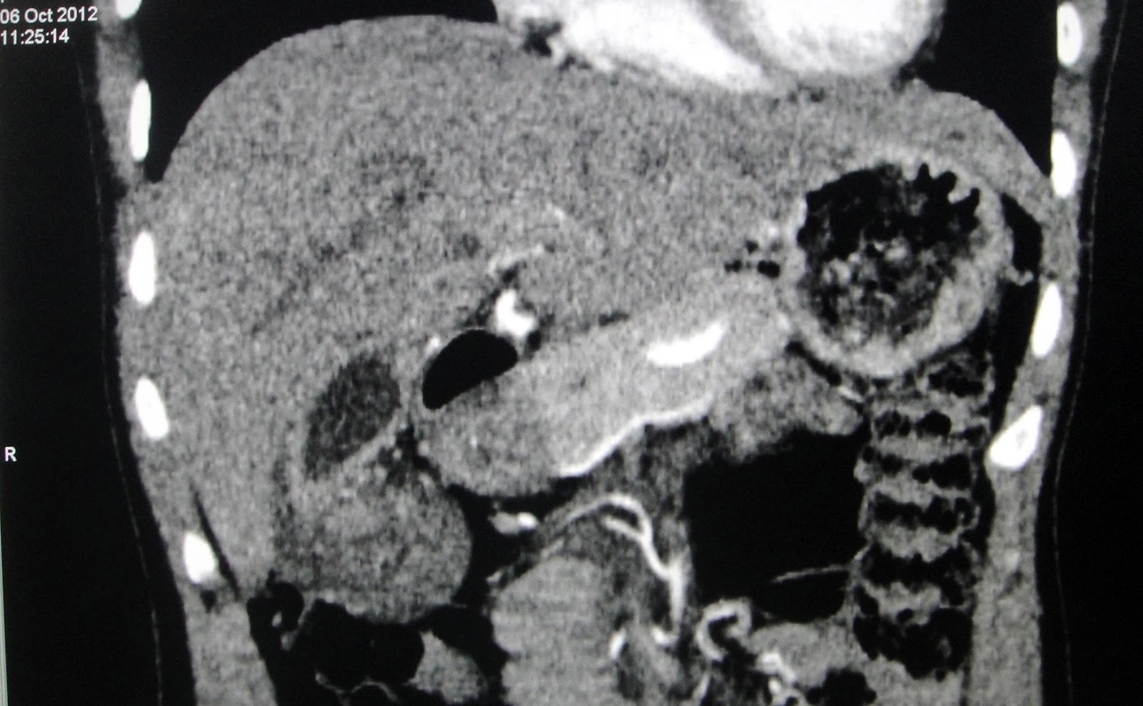 VIETNAMESE MEDIC ULTRASOUND: CASE 144: ABNORMAL GALL BLADDER, Dr PHAN ...