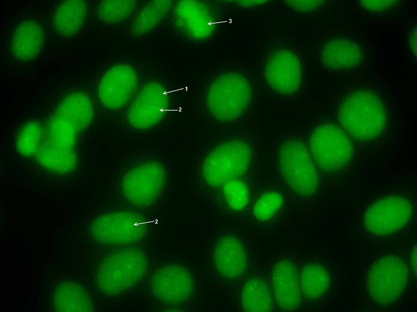 Anticorpos anti - Scl70
