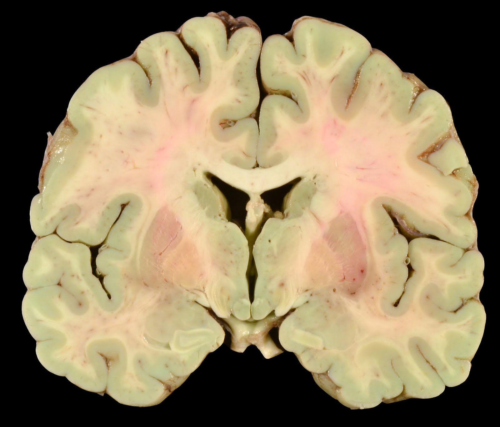 neuropathology blog: Guest Post from Dr. PJ Cimino: Blue discoloration ...