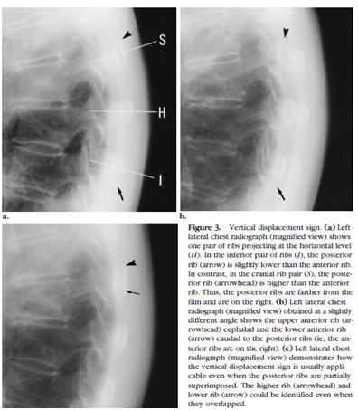 Chest Medicine Made Easy-Dr Deepu: The “BIG RIB SIGN” and “VERTICAL ...