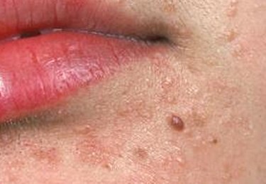 Photos of Skin Tags on Face ~ How To Remove Moles, Warts, Skin Tags Safely