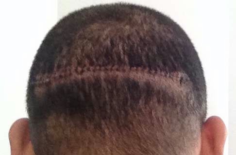 hair transplant experience - pengalaman transplantasi rambut / tanam ...