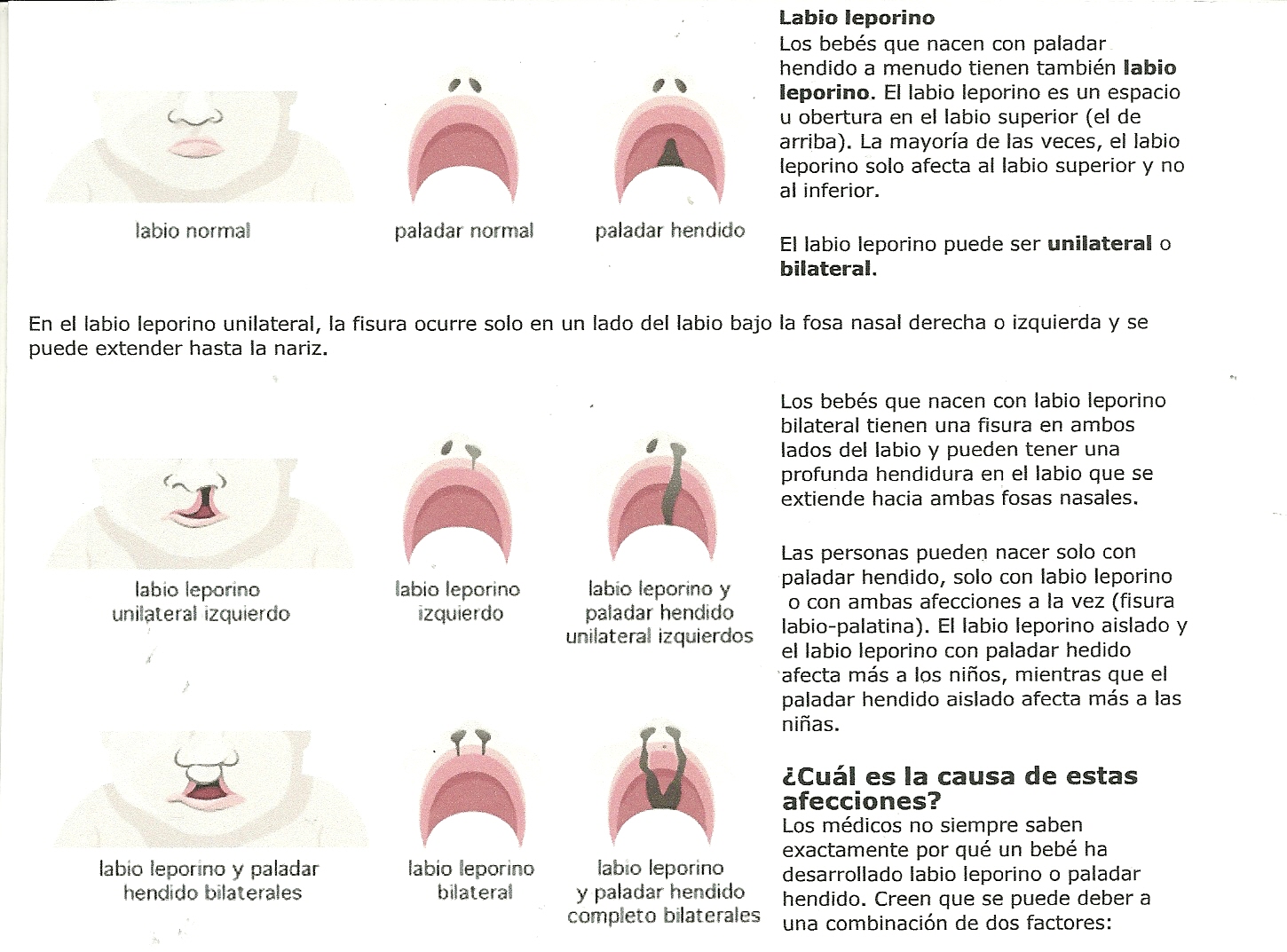 jaitt odonto social: FISURA LABIO-ALVEOLO-PALATINA