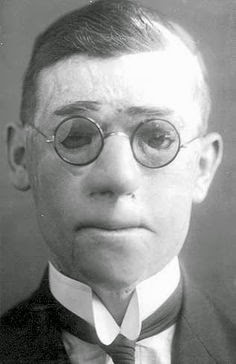 Walter Yeo Skin Graft