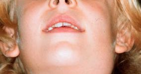 Parotitis တံေတြးထြက္အိတ္ေရာင္ျခင္း