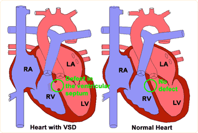 Ventricular Septal Defect - Mydokterhewan