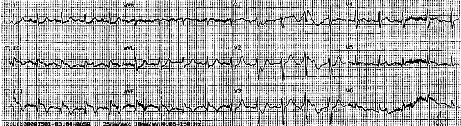 Dr. Smith's ECG Blog: Pulmonary Edema, Hypertension, and ST Elevation 2 ...