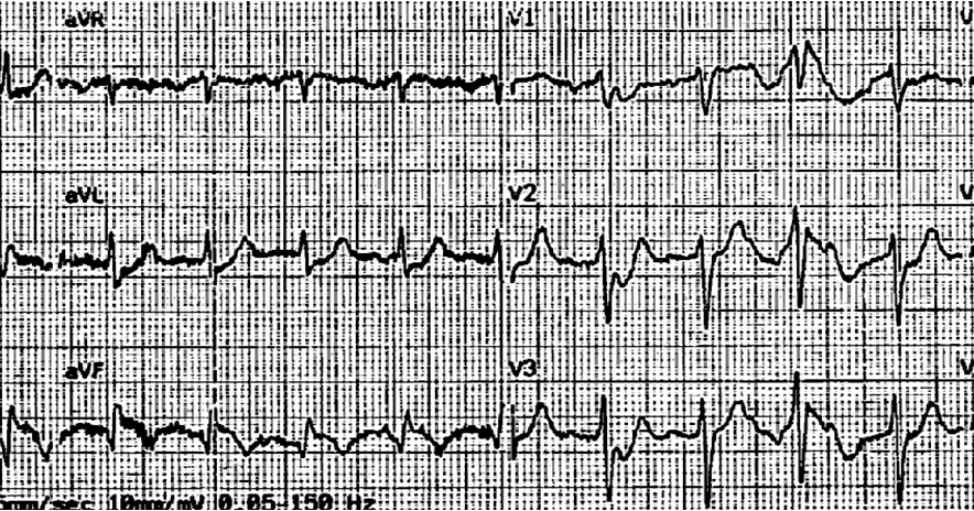 Dr. Smith's ECG Blog: Pulmonary Edema, Hypertension, and ST Elevation 2 ...