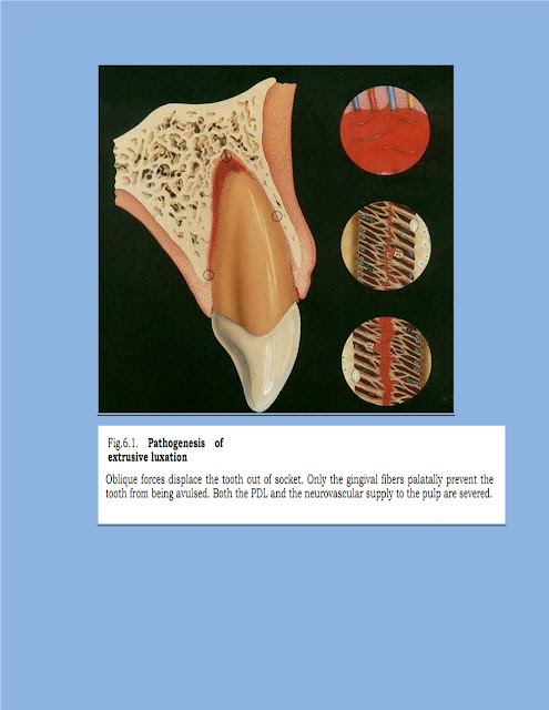 DOs and DONTs in DENTISTRY: CONCUSSION ,SUBLUXATION,EXTRUSION ,LATERAL ...