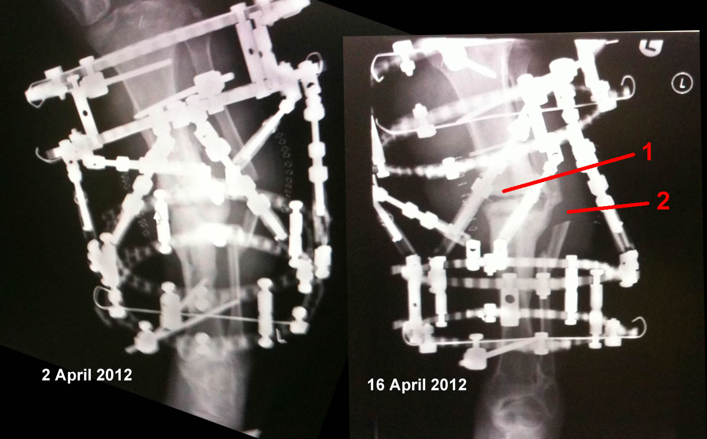 ajmk - est. 1974: Hospital, X-rays, Bolt cutters (!), Adjustment 4