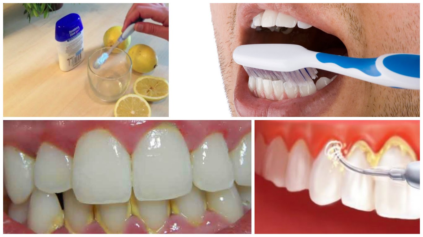 ¿Cómo eliminar el sarro de manera natural?