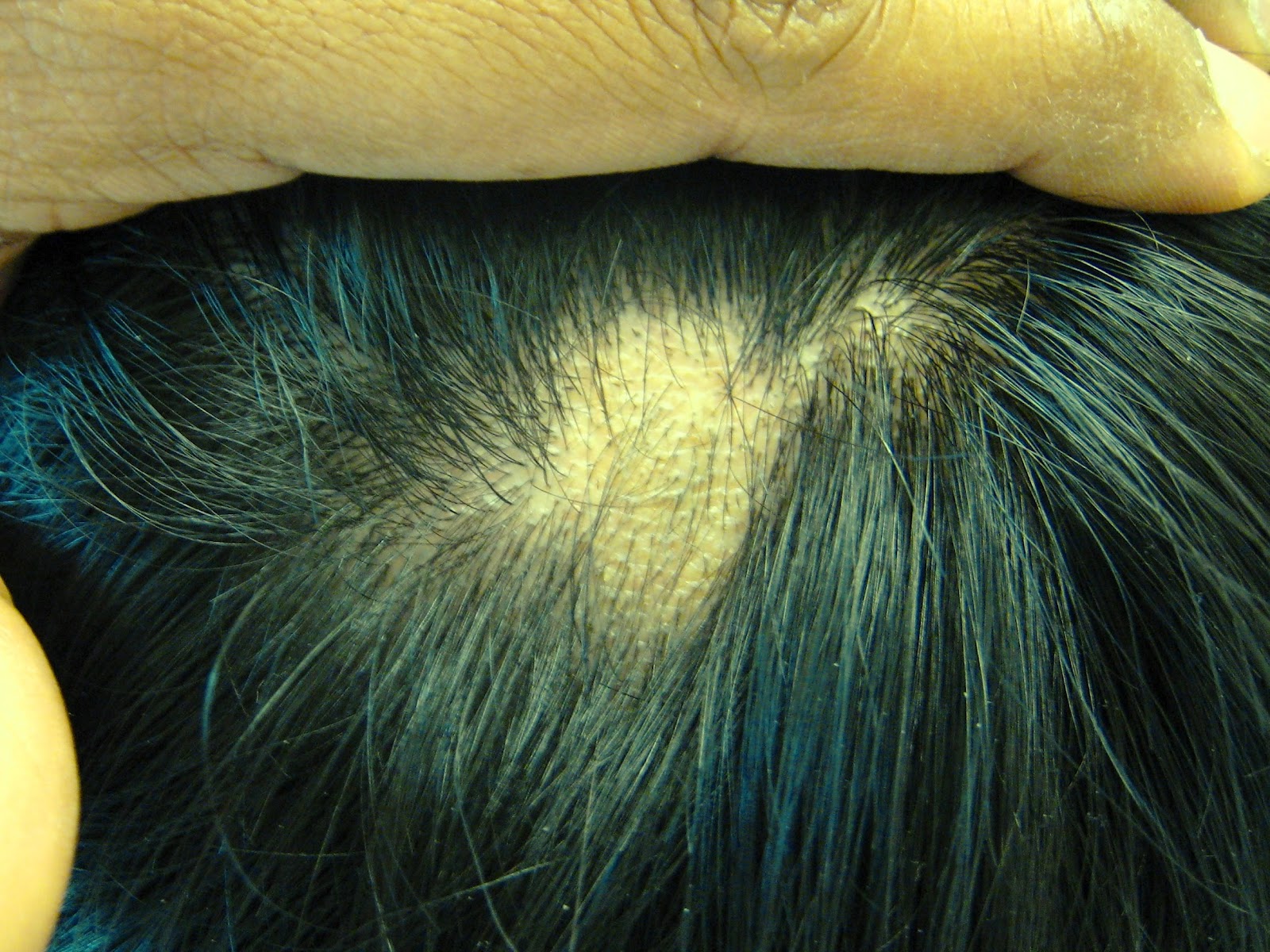 HEALTH FROM TRUSTED SOURCES: Hair loss / Alopecia
