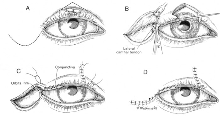 Eyelid Surgery by Prof Dr CN CHUA 蔡鐘能: February 2011