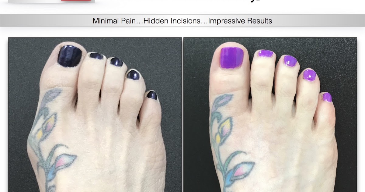 The Sklar Bunionectomy. NO casts, NO crutches and NO visible scars 💫 ...