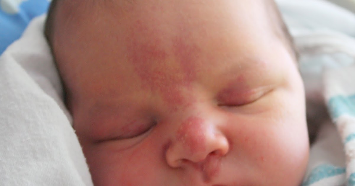 Martin Family Moments: The Fading Birthmark