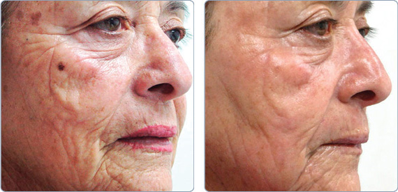 Pixel Skin Resurfacing by Beauty Redefined