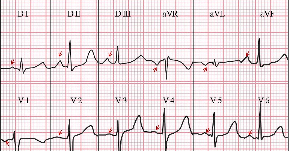 Tutomedic: RUTINA DE INTERPRETACIÓN DEL ECG:4- Onda P