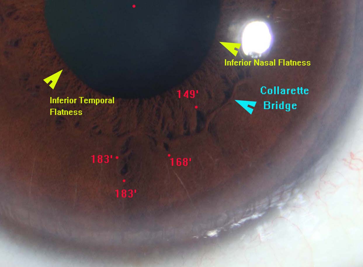 Modern & Multidimensional Iridology: Pupil Flattenings, Linear ...