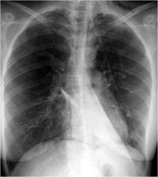 RADIOLOGY IMAGE SPOTTERS: Left lower lobe collapse