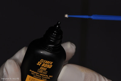 M. Vestphal - Odontologia Estética: Restauração Classe V com Resina ...