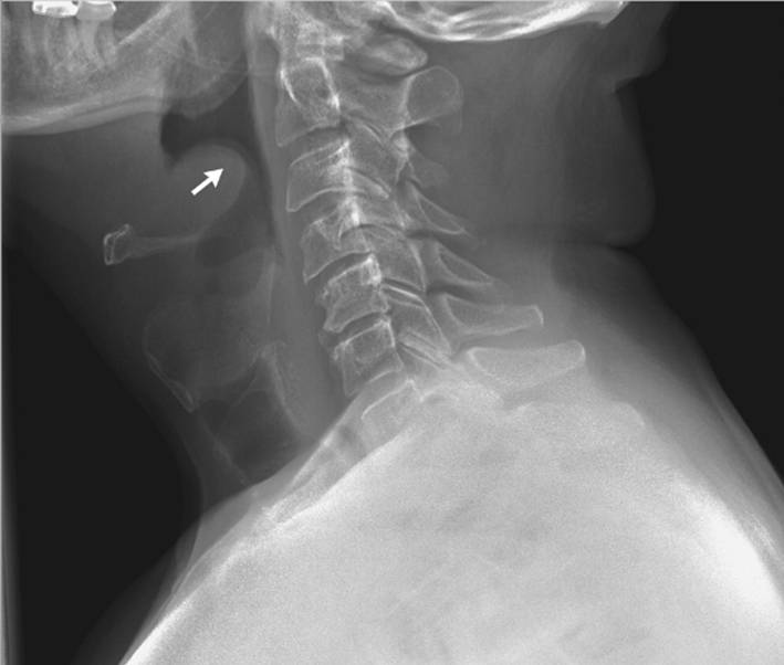 Phimaimedicine: 1,248. Acute infectious epiglottitis