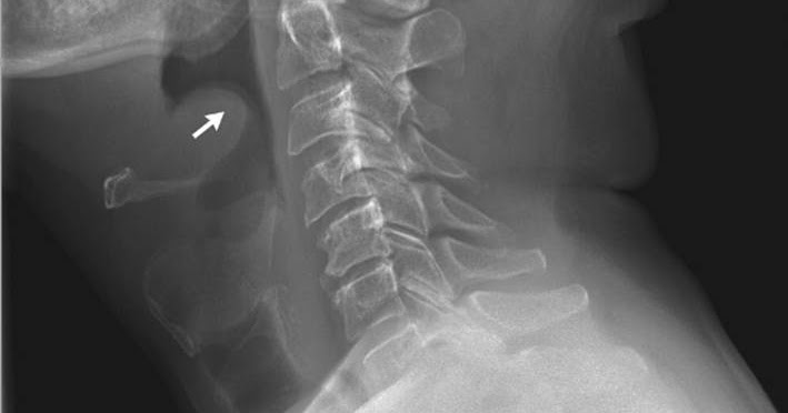 Phimaimedicine: 1,248. Acute infectious epiglottitis