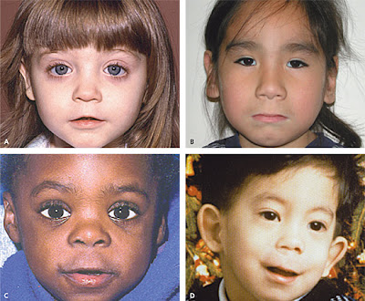 Fetal Alcohol Syndrome