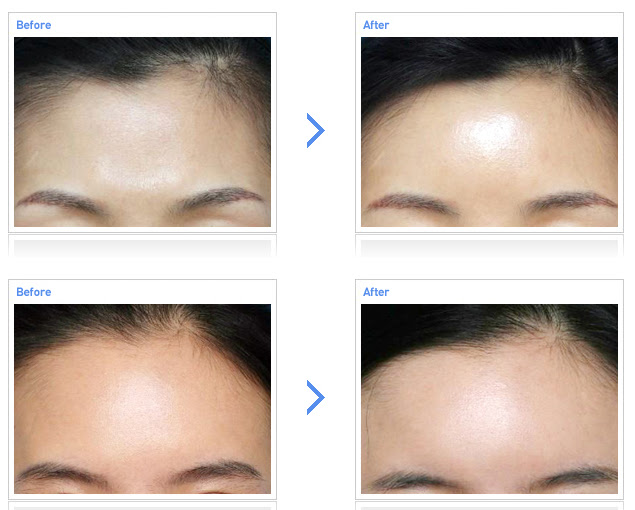 Grand Plastic Surgery: Forehead augmentation by Fat Grafting