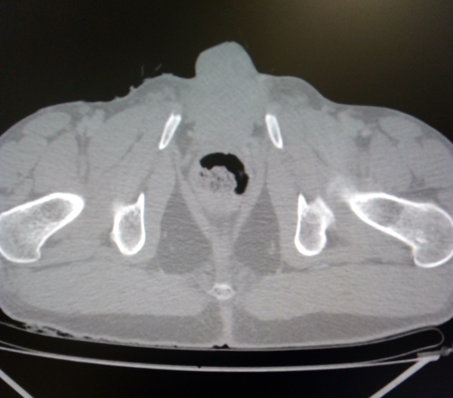 Bladder exstrophy – CT - Sumer's Radiology Blog