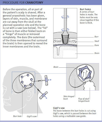 Procedure For Craniotomy ~ Nursing