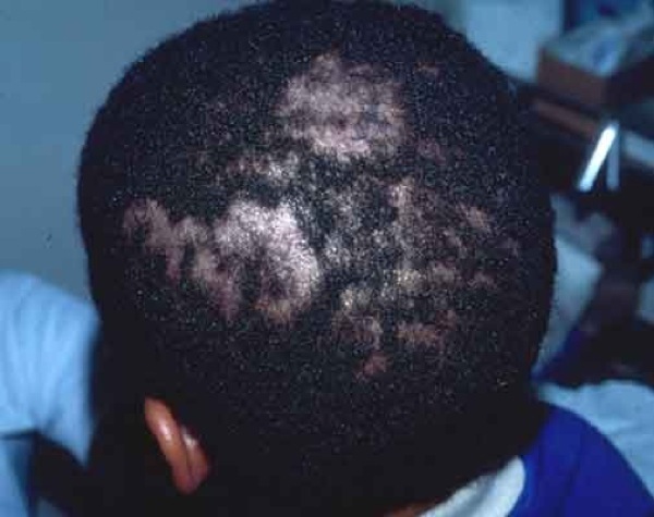 Doctors Gates: Between Tinea capitis and Psoriasis of the scalp