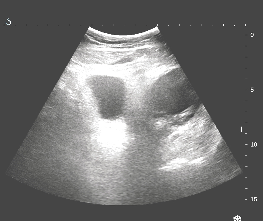 VIETNAMESE MEDIC ULTRASOUND: CASE 402 : DOUBLE URINARY BLADDER, Dr PHAN ...