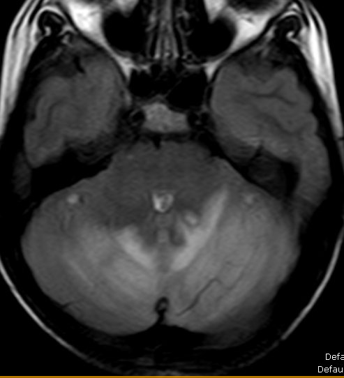 Acute Cerebellitis-is it infectious or post infectious? - Sumer's ...