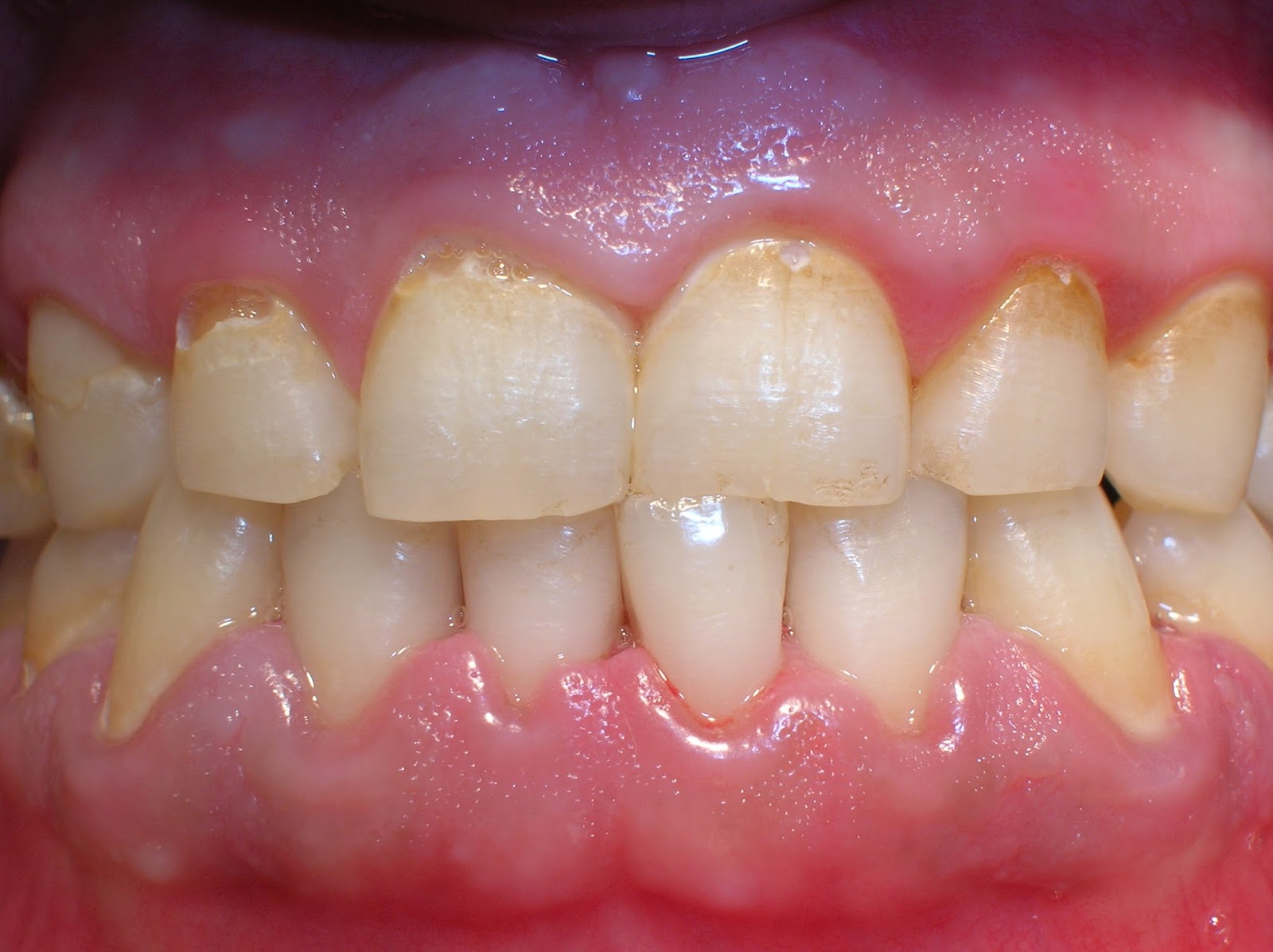 Odontología Preventiva: MATERIA ALBA