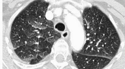 Chest Medicine Made Easy-Dr Deepu: BASICS OF HRCT INTERPRETATION-PART 2 ...