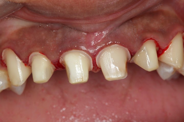 Understanding Prosthodontics - Tagore Dental College & Hospital-By ...