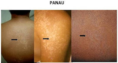 .:essence of zarraz paramedical: Panau