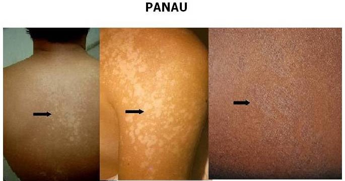 .:essence of zarraz paramedical: Panau