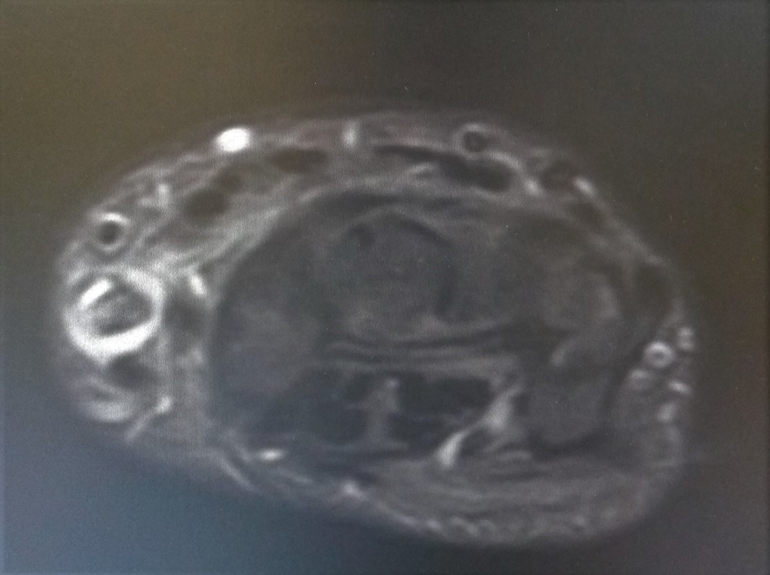De Quervain Tenosynovitis: MRI - Sumer's Radiology Blog