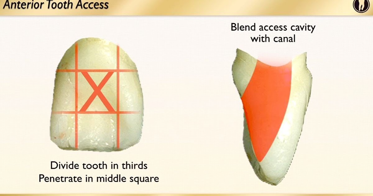 ENDODONTIC: Anterior Tooth Access - Dr. Reid Pullen - Odonto-Tv
