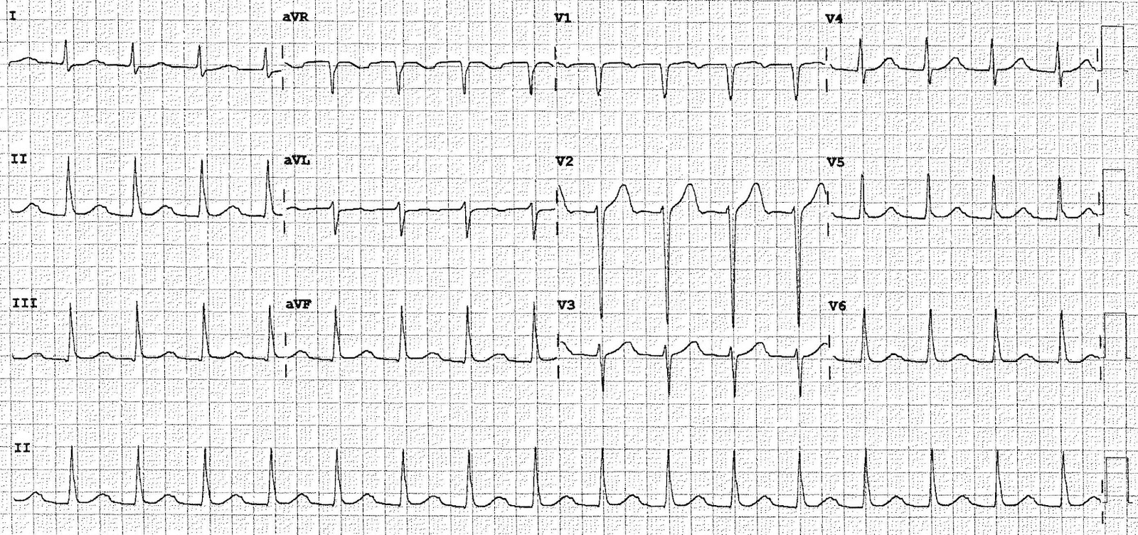 ECG of the Week: ECG of the Week - 5th December 2016 - Interpretation
