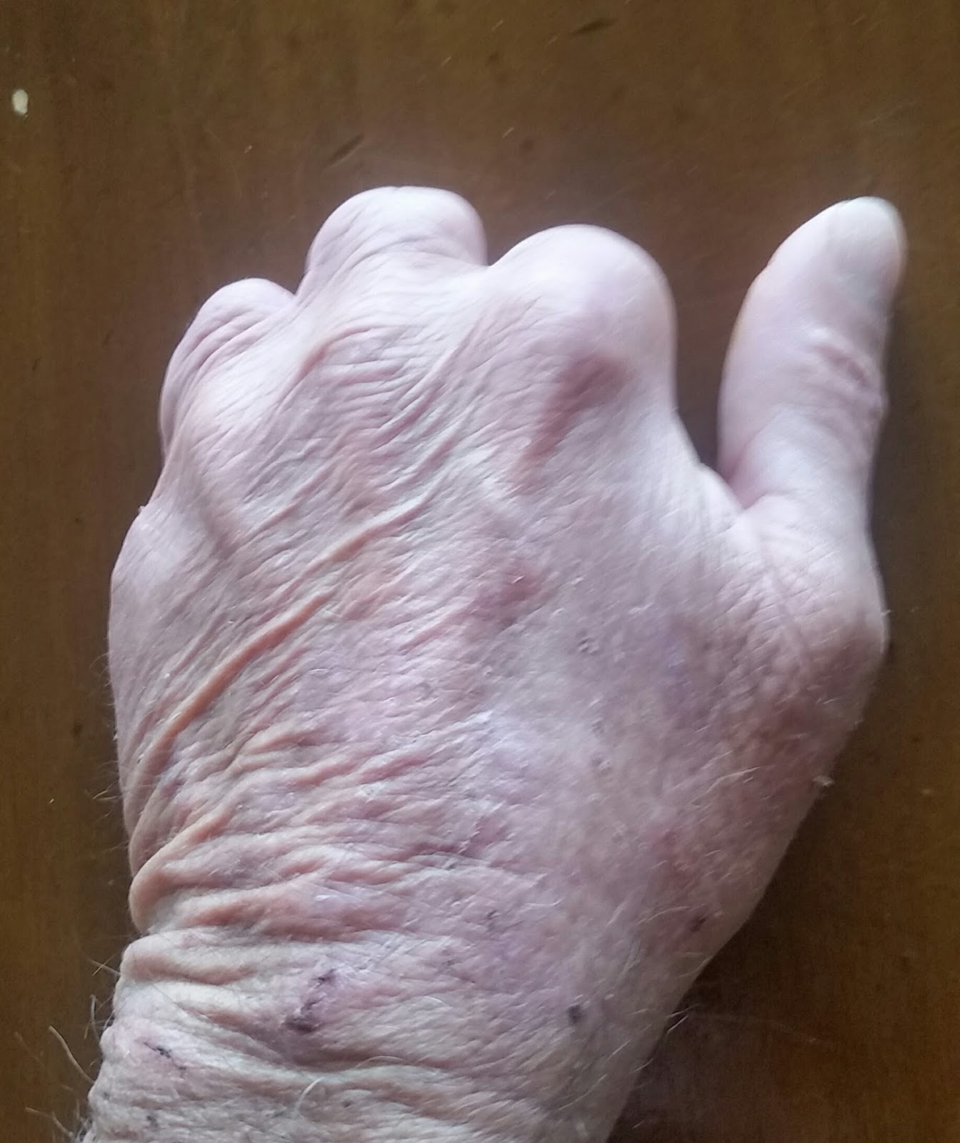 Velo Vortmax: Finger Frostbite Amputation Photographs