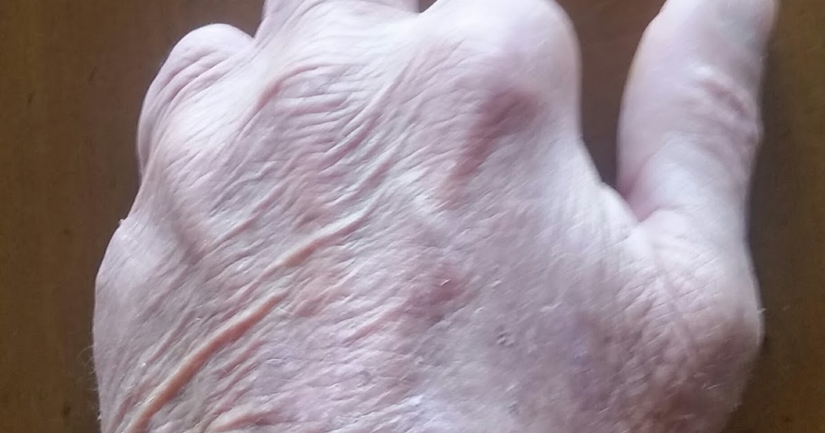 Velo Vortmax: Finger Frostbite Amputation Photographs