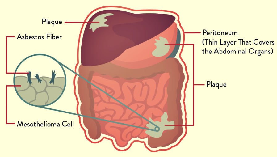 Peritoneal Mesothelioma - Asbestos
