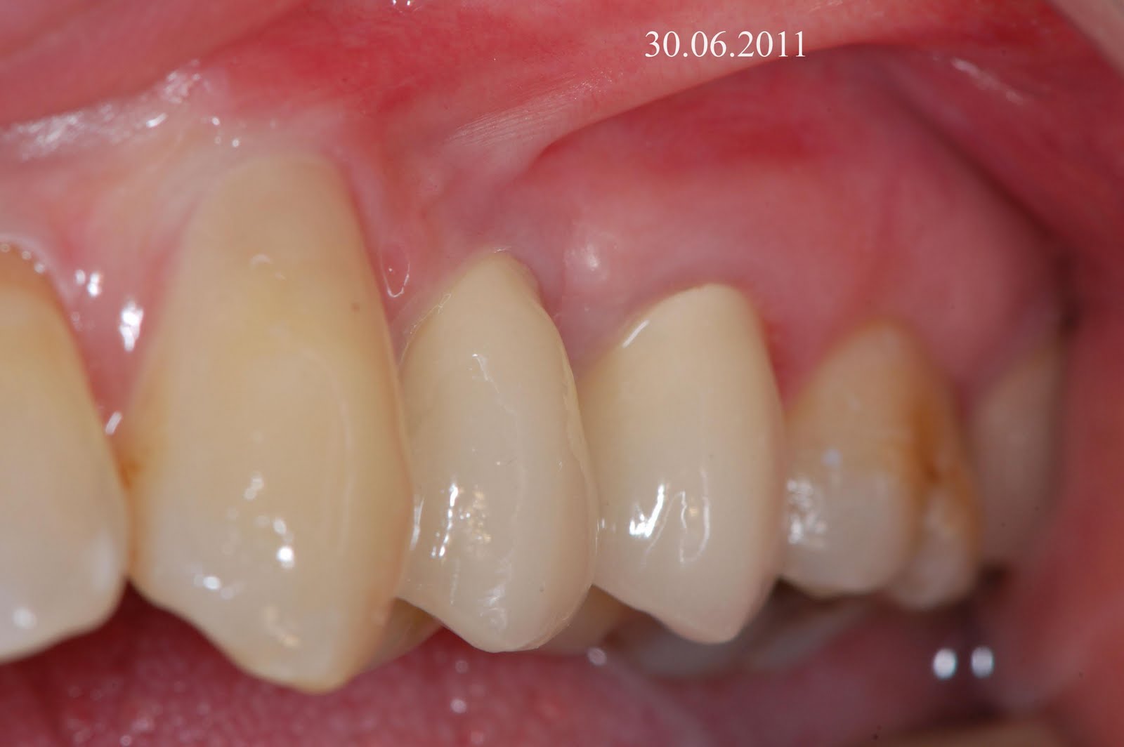 Docteur J.M. STROUMZA: PROFIL D’EMERGENCE : CLEF DE PERENITE IMPLANTAIRE